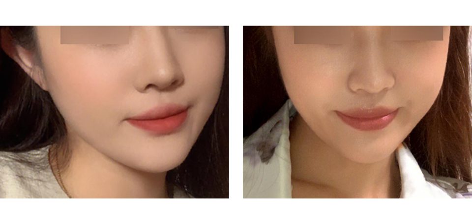 파워v얼굴지방흡입v라인 앞볼 후기 닥터정 리반의원