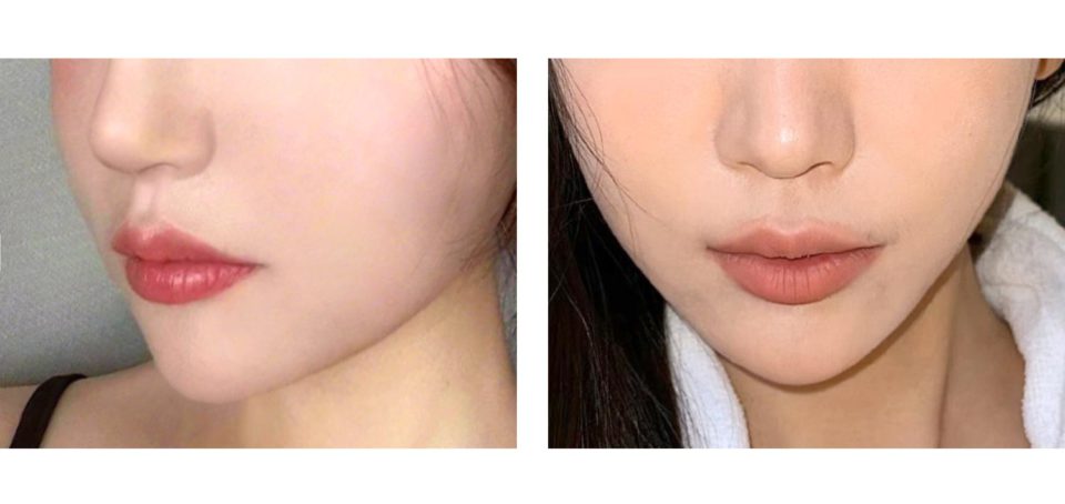 파워v얼굴지방흡입 실리프팅 후기 닥터정 리반의원