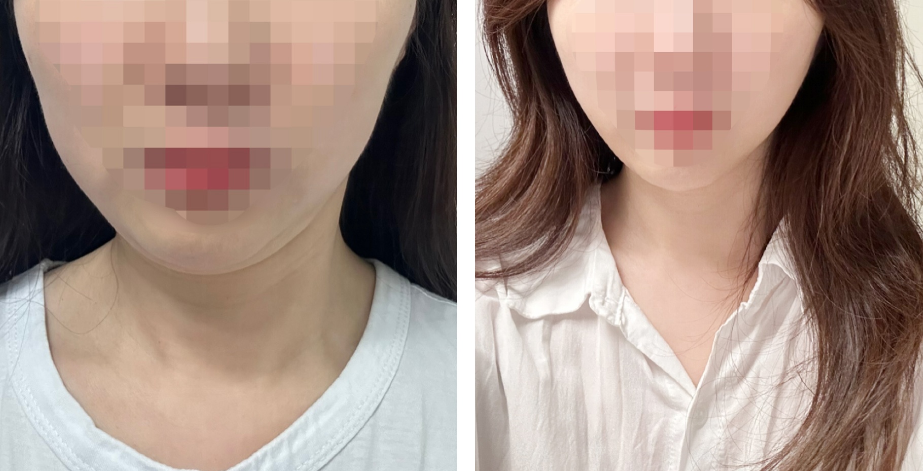 파워v얼굴지방흡입v라인앞볼 민트4 픽스4 자갈턱보톡스 후관리 닥터정 리반의원