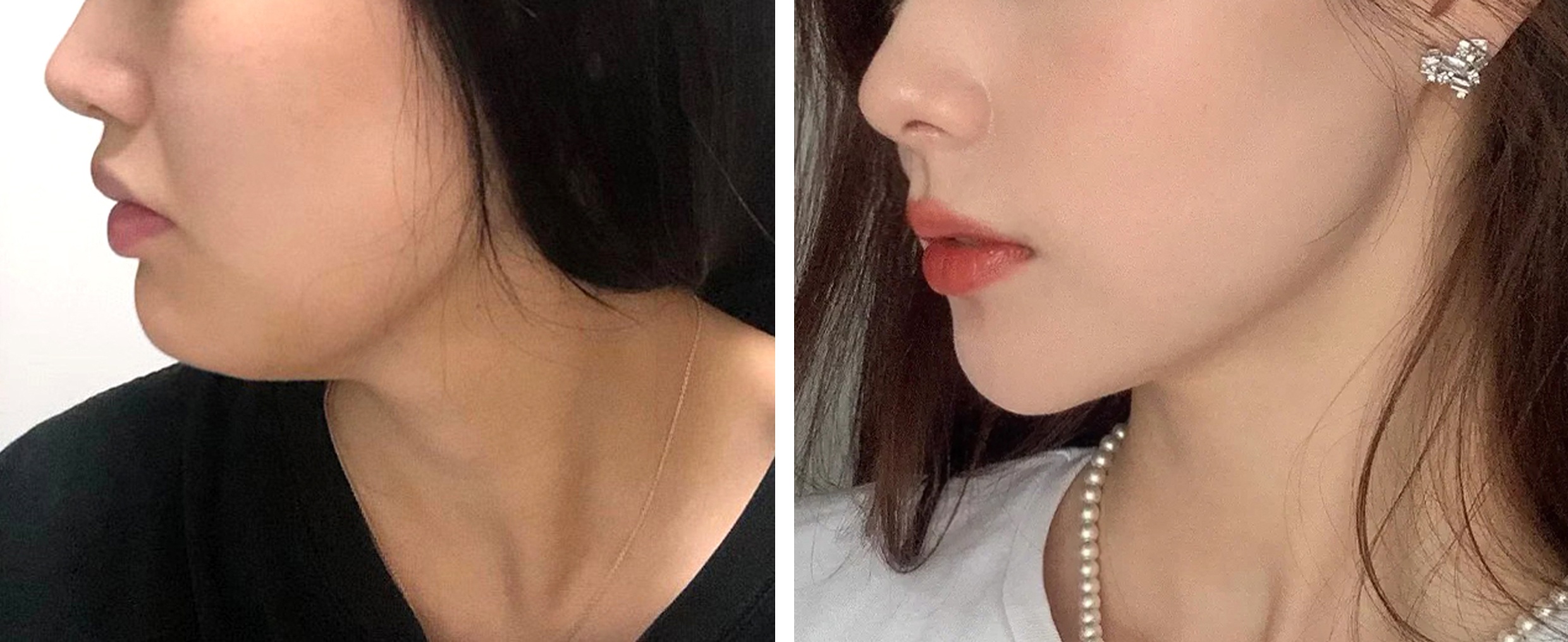 파워v얼굴지방흡입 팔자젠틀리프팅 4d타이트업실리프팅 사각턱보톡스 침샘보톡스 후관리 20 닥터정리반