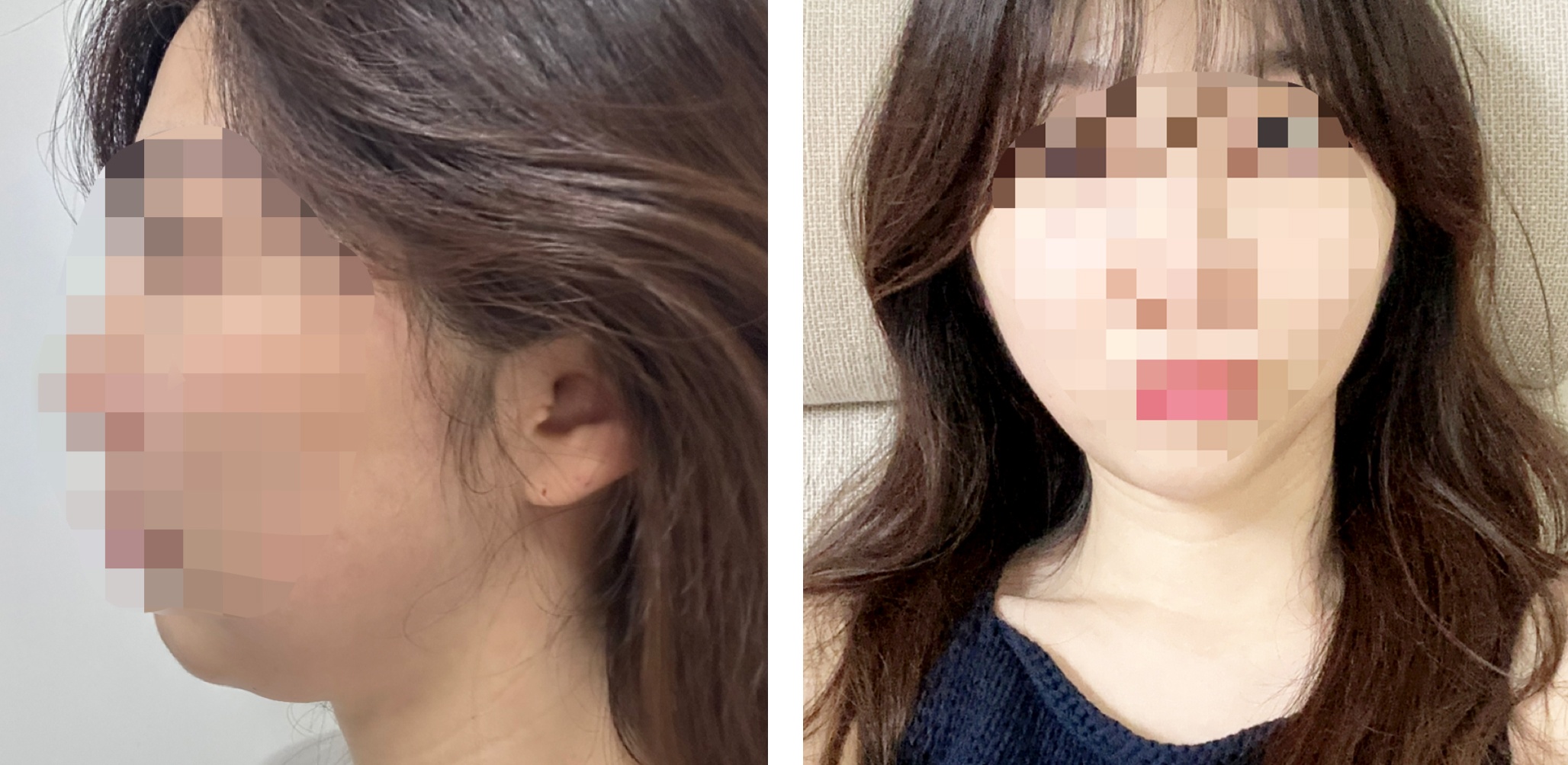 파워v얼굴지방흡입v라인앞볼 민트실리프팅 자갈턱 보톡스 후관리 닥터정리반 닥터정 리반의원