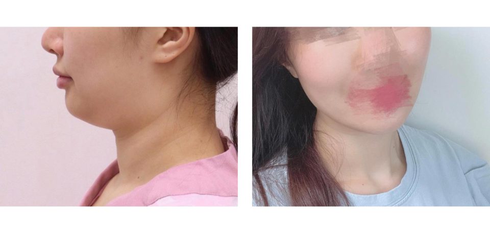 파워v얼굴지방흡입앞볼 이중턱 옆볼 실리프팅 침샘보톡스 6개월차 후기 닥터정 리반의원
